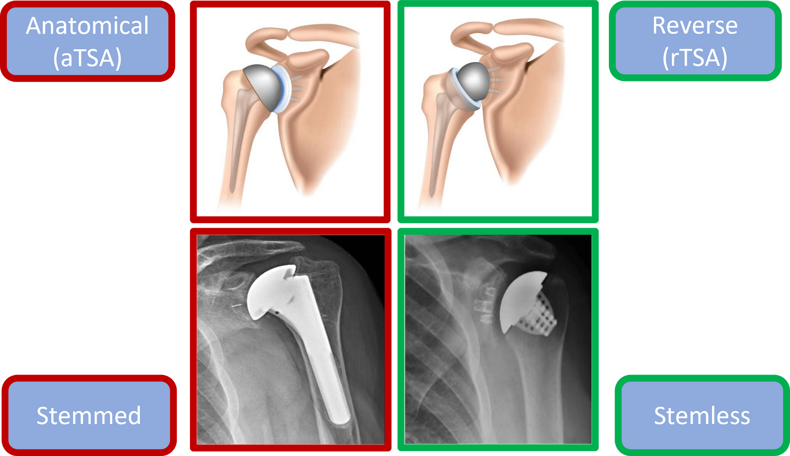 Exactech - Reverse Stemless Shoulder Arthroplasty