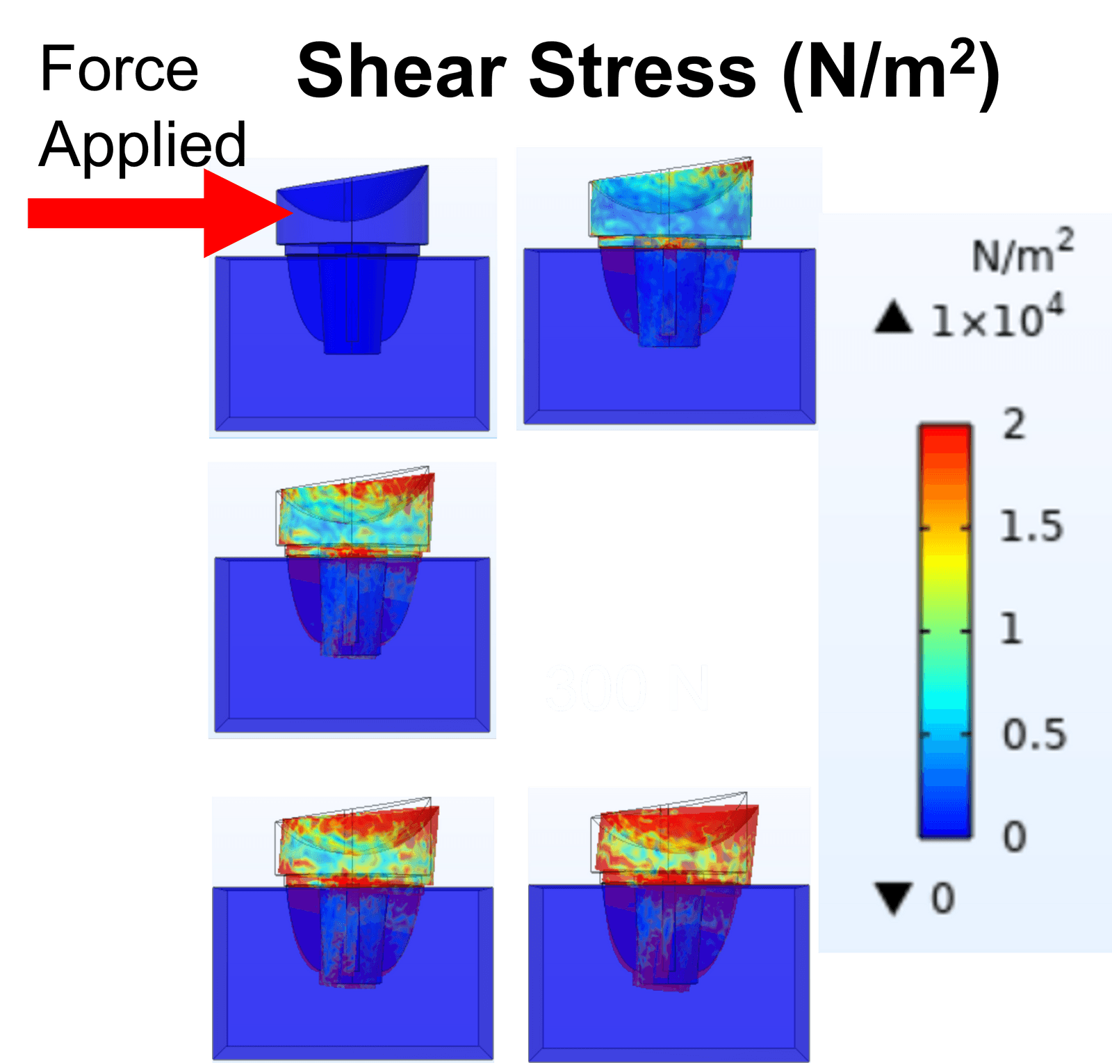 Exactech - Reverse Stemless Shoulder Arthroplasty