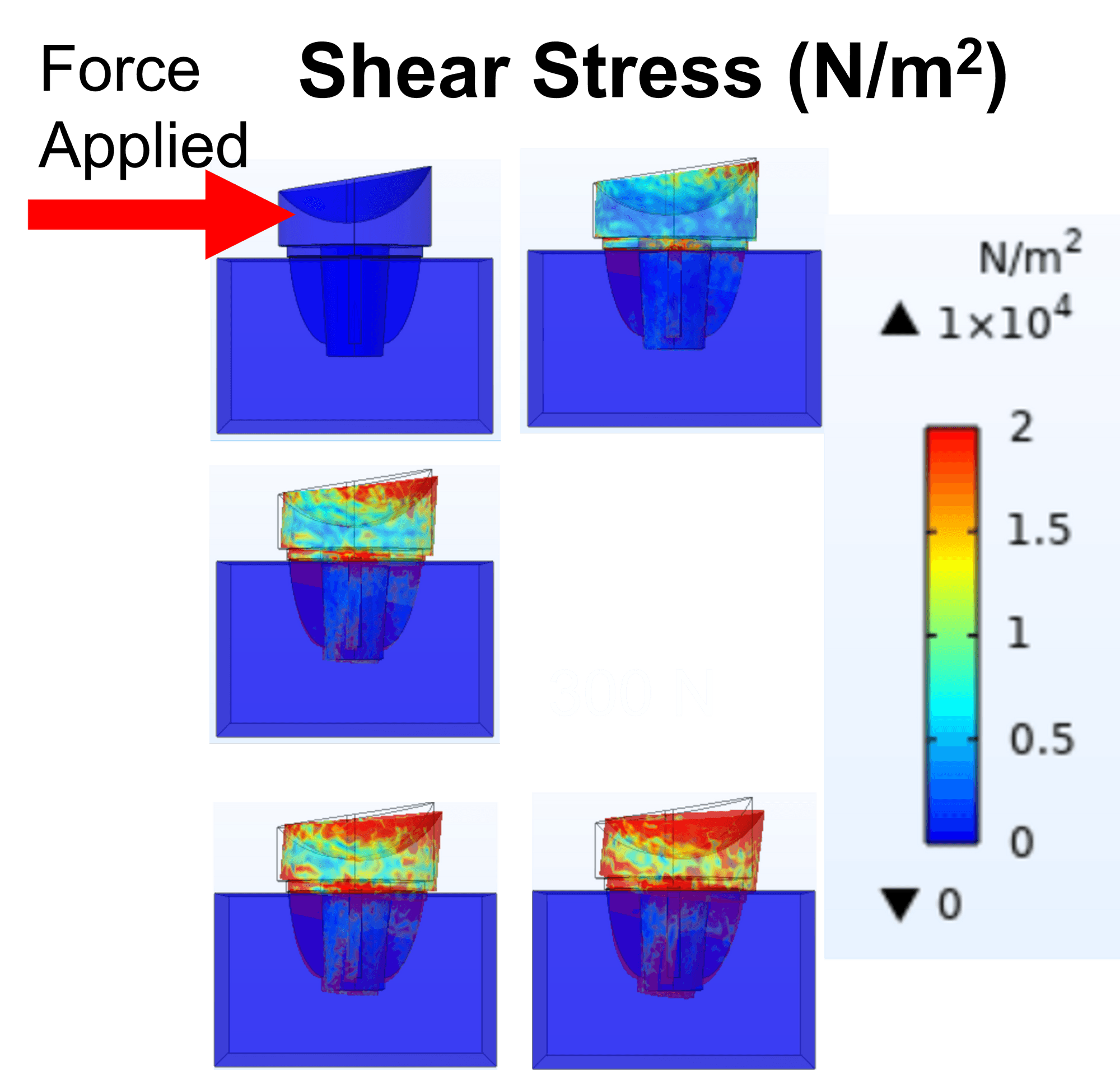 Exactech - Reverse Stemless Shoulder Arthroplasty
